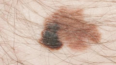 Fast-tracked skin cancer drug pembrolizumab gets approval - BBC News