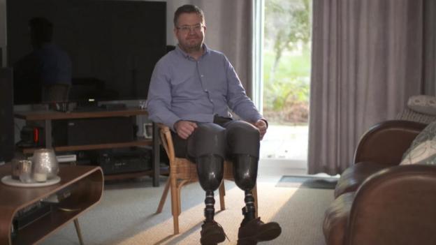 Sepsis: What losing his legs taught surgeon about life - BBC News