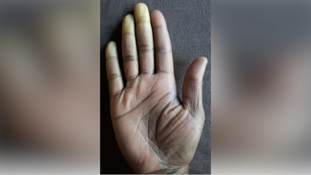 Raynaud's: Suffolk man's cold fingers were caused by disease - BBC News