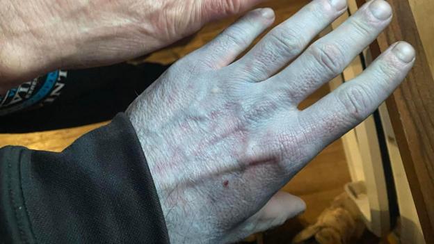 Man's blue skin A&E panic was just bed sheet dye - BBC News