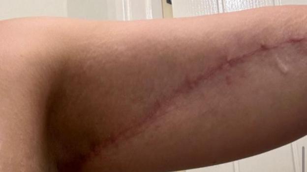 'I paid £6k to to feel worse than I did before the surgery - BBC News