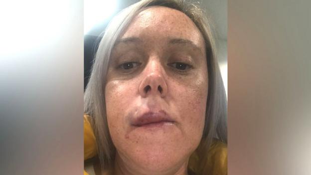 Scotland ‘worst in Europe’ for unregulated fillers - BBC News