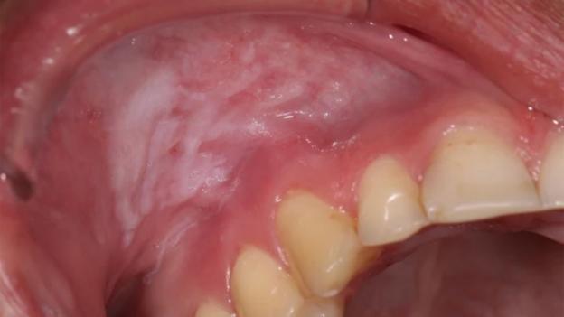 The rising use of nicotine pouches snus - and risk to gums and teeth ...