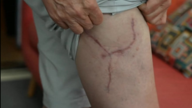 Warwickshire: Hippo attack survivor's new outlook on life - BBC News