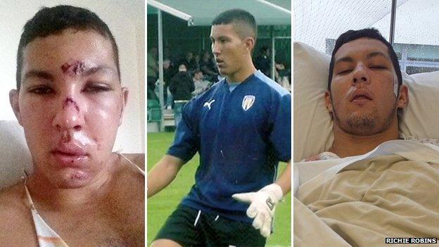 Wivenhoe Town goalkeeper attack: Surgery for Richie Robins - BBC News