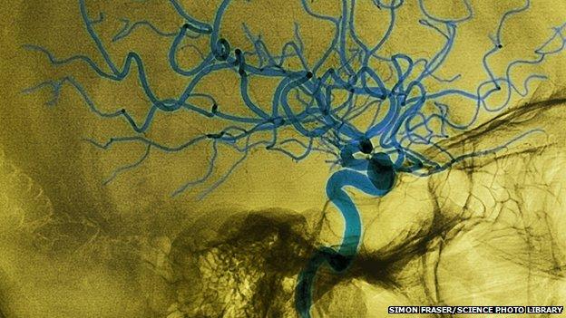 Microwave helmet 'can spot a stroke' - BBC News