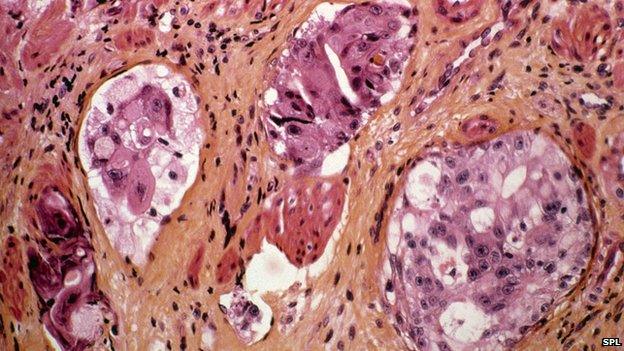 Botox may have cancer fighting role - BBC News