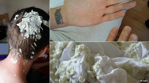 Cavity foam Halloween attack leaves Southend man burnt - BBC News