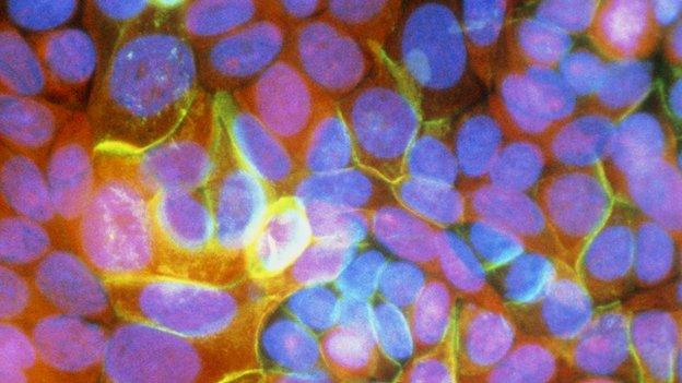 Family breast cancer 'as treatable' as other tumours - BBC News