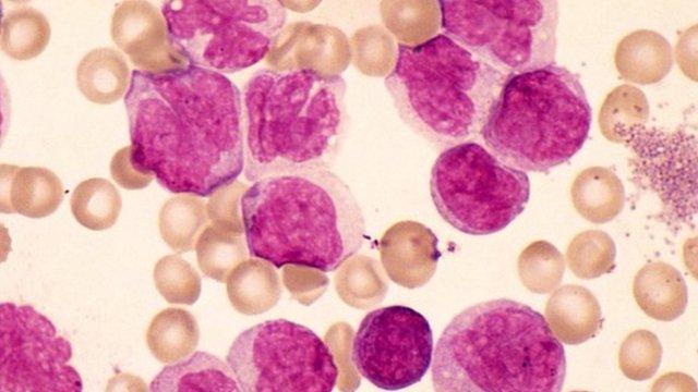 Diabetes drug may help in leukaemia - BBC News