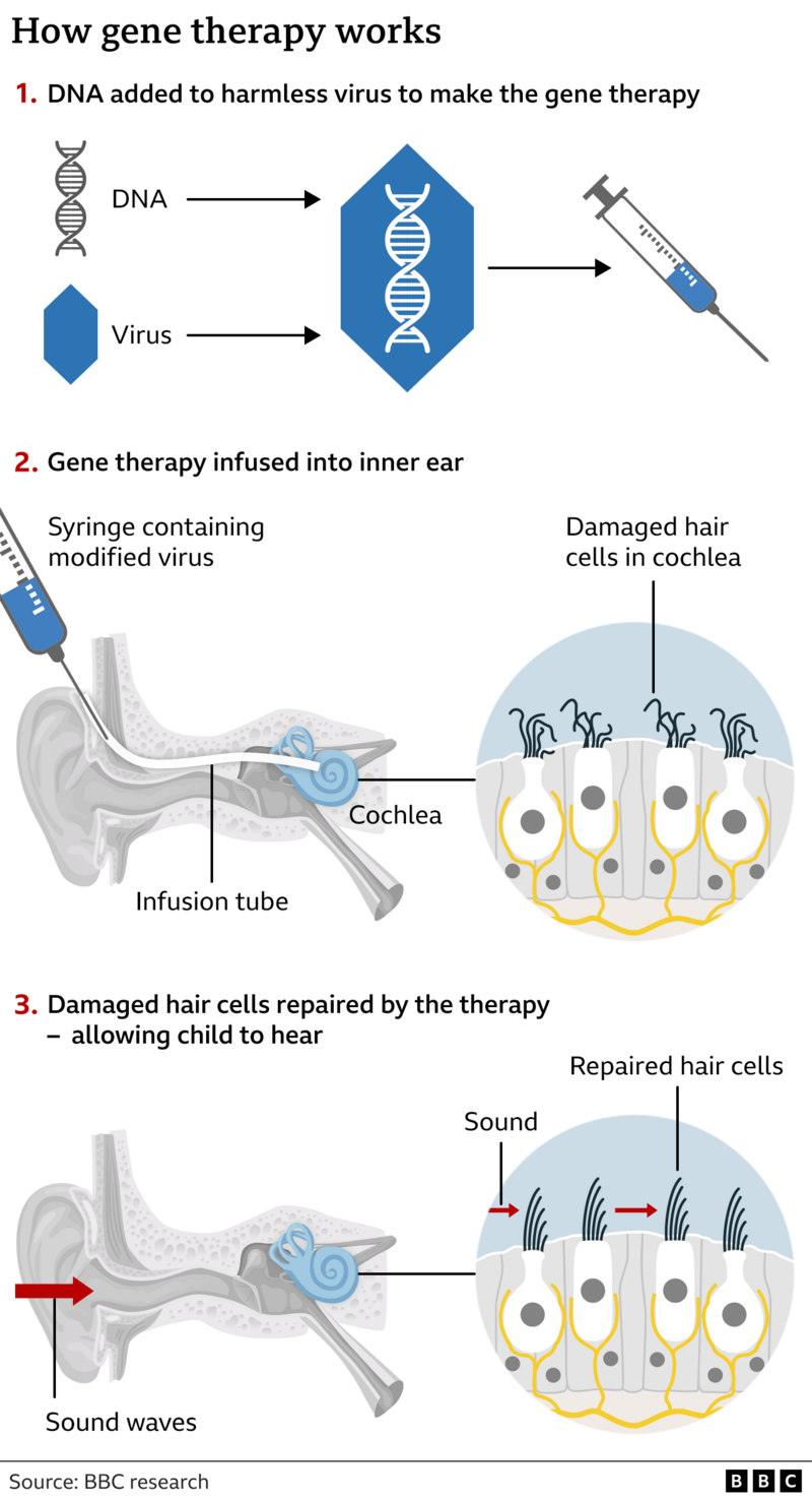 Pioneering gene therapy restores UK girl's hearing - BBC News