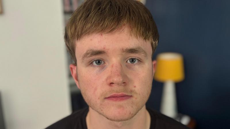 Male pattern baldness: 'Losing my hair at 16 has controlled me' - BBC News