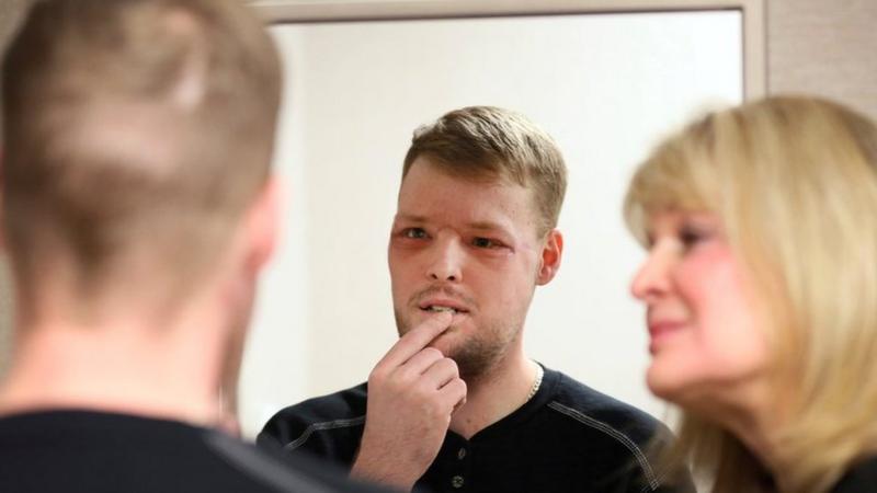 Face transplant: A 'second chance' for young suicide survivor - BBC News
