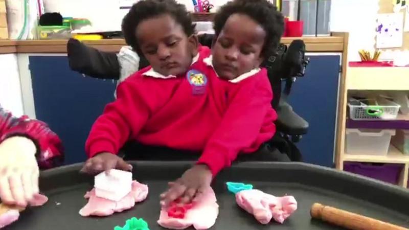 Conjoined twins given days to live are proving world wrong - BBC News