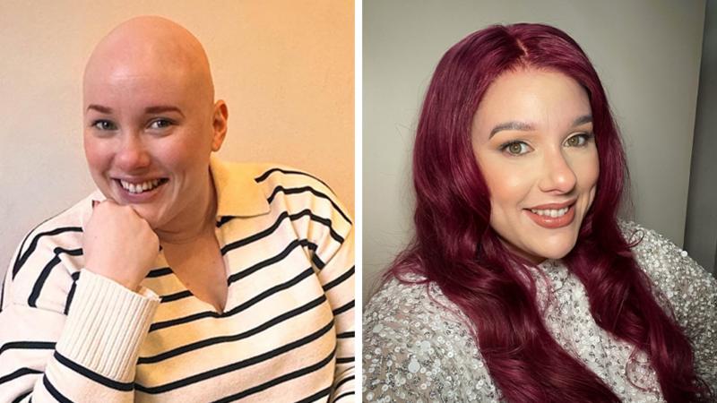 'There is no right or wrong way to have alopecia' - BBC News