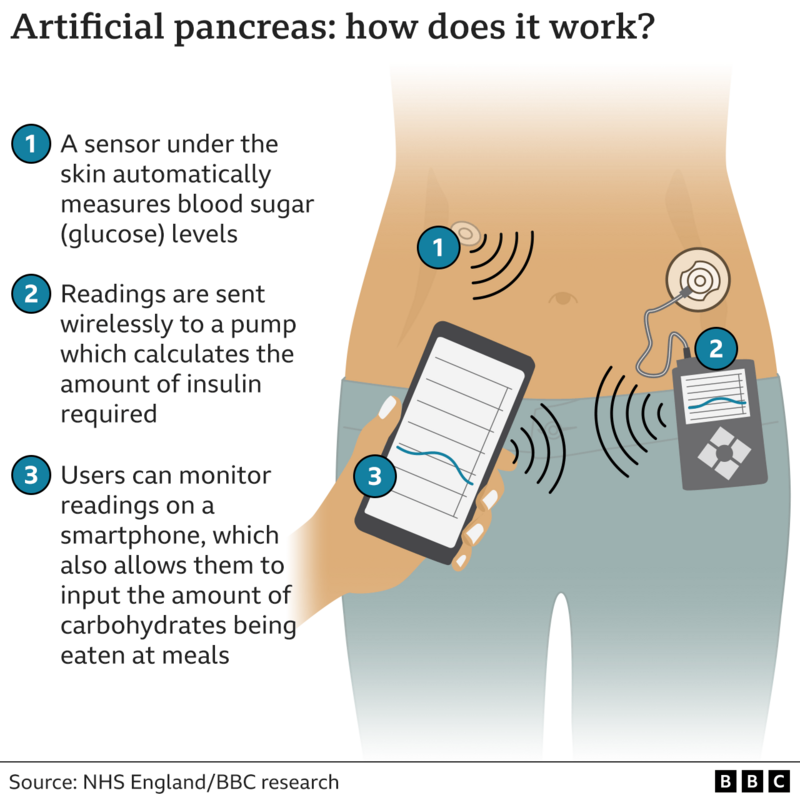 Diabetes patients to be offered artificial-pancreas technology - BBC News