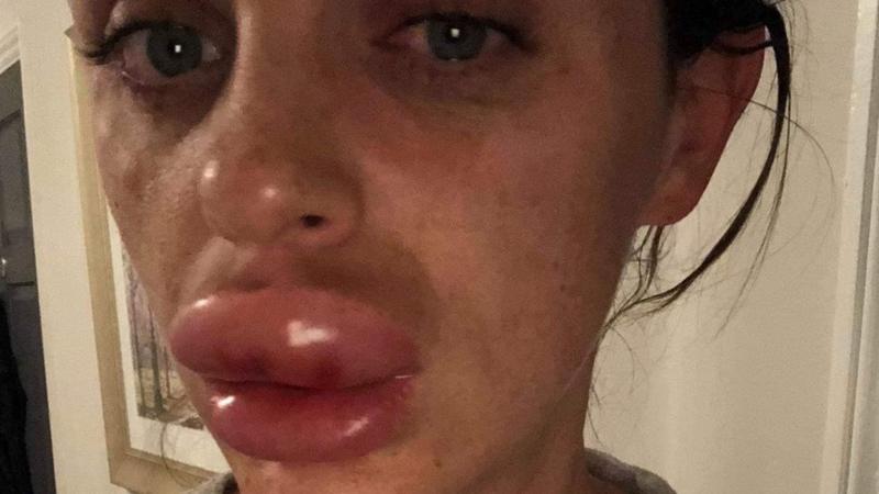 Mental Health: Tougher checks before Superdrug Botox - BBC News