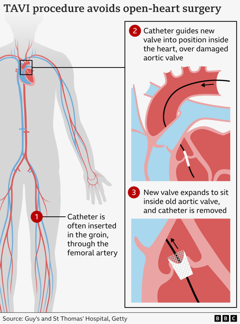 Police launch investigation into heart operation deaths at NHS hospital ...