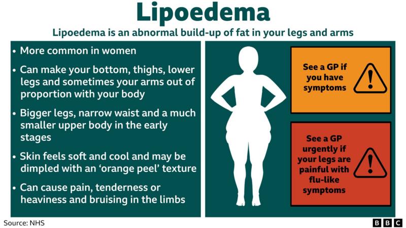 Lipoedema: Love Island star helped me find 'fat built-up' condition ...