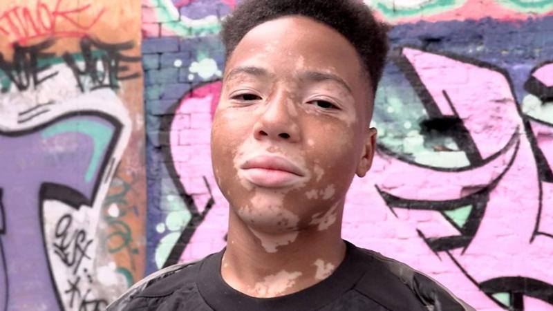 Vitiligo: Controversial skin cream may come to UK - BBC News