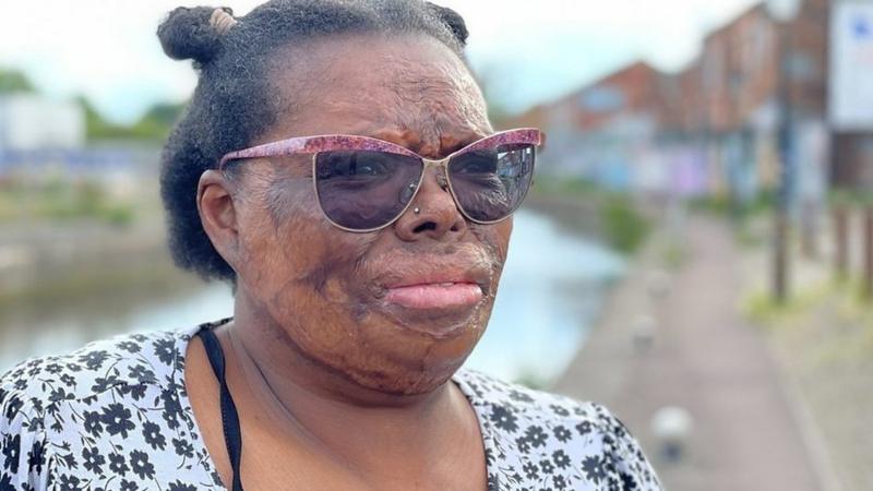 Facial disfigurement - BBC News