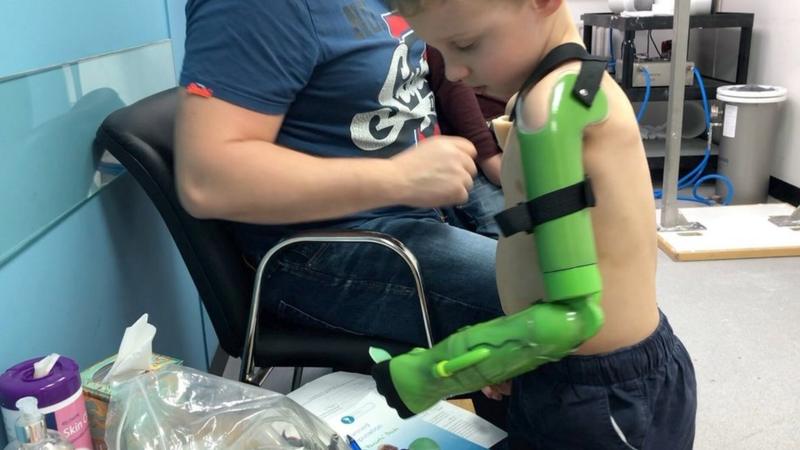 Boy, 5, given prosthetic arm that lets him hug brother - BBC News