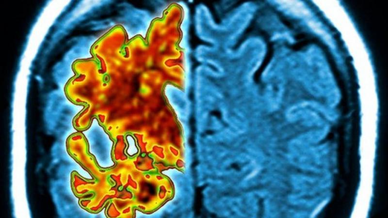 NHS to try out Alzheimer's disease blood tests - BBC News