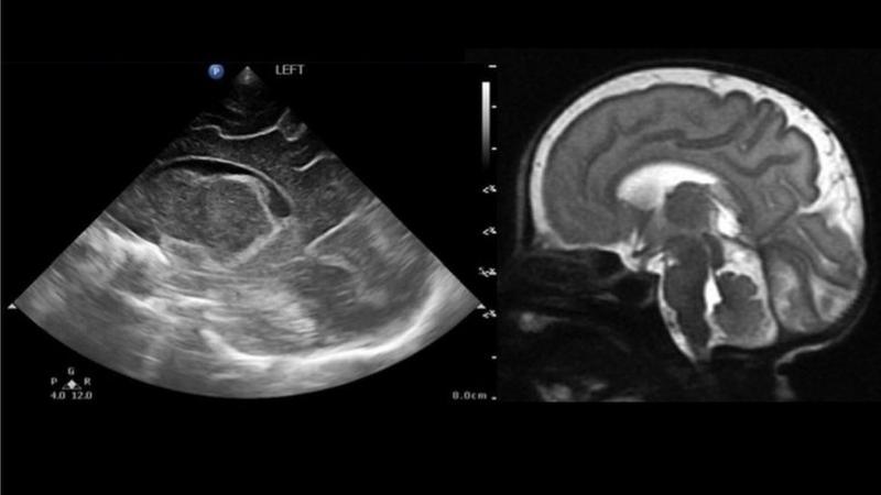 World's smallest MRI helps tiny babies - BBC News