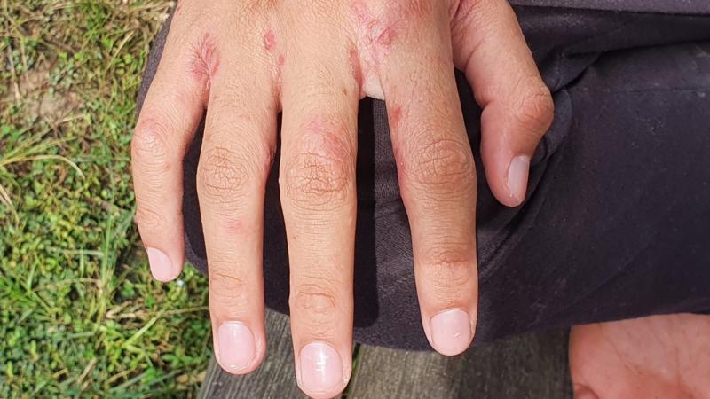 Scabies: Doctors warn people not to ignore rash - BBC News