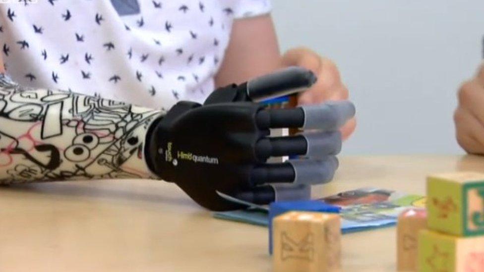 Touch Bionics sold to Icelandic firm Ossur - BBC News