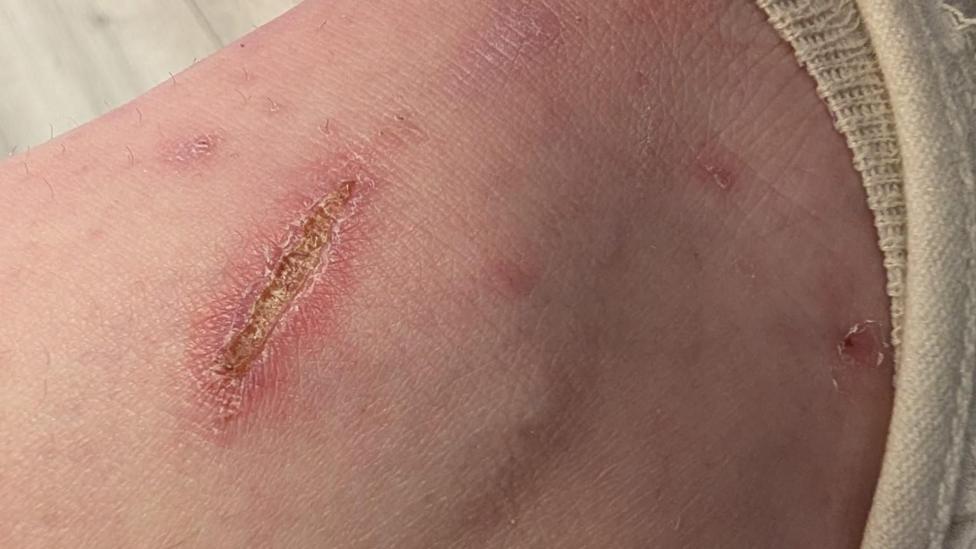 Mum's scabies 'nightmare' as cases of parasitic infestations rise - BBC ...