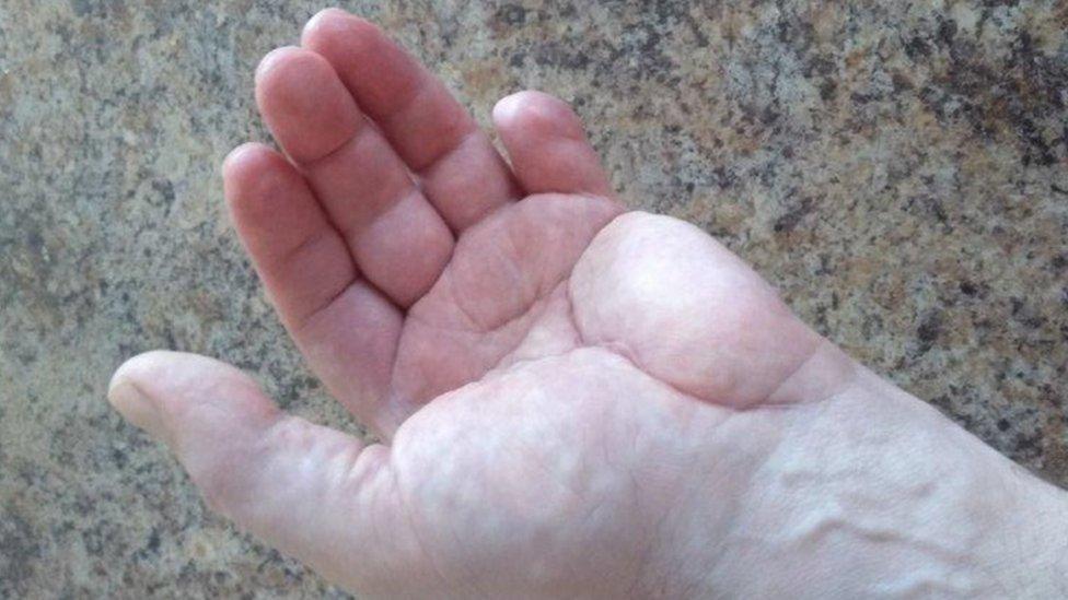 Morriston Hospital staff praised for saving man's severed hand - BBC News