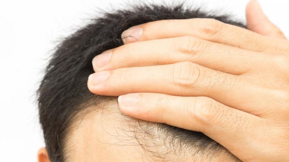 Hair loss: What is female-pattern baldness? - BBC News
