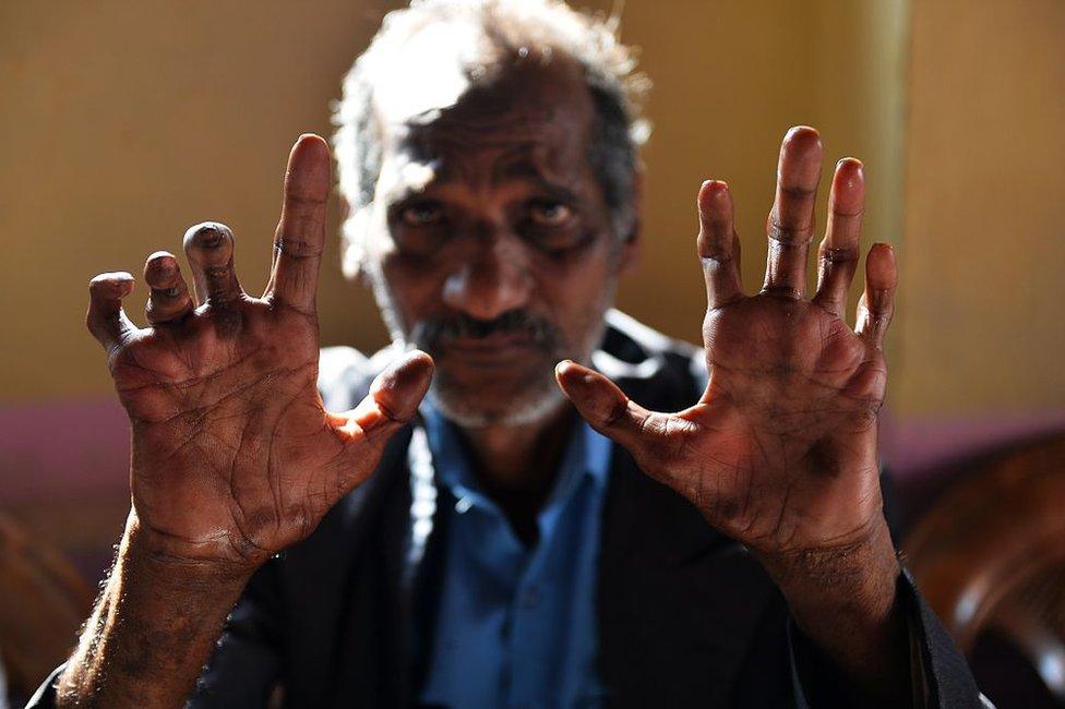 Vaccine brings new hope to India's largest leprosy colony - BBC News
