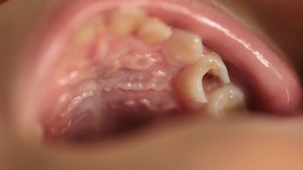 Blackpool Council approves fluoridated school milk plan - BBC News