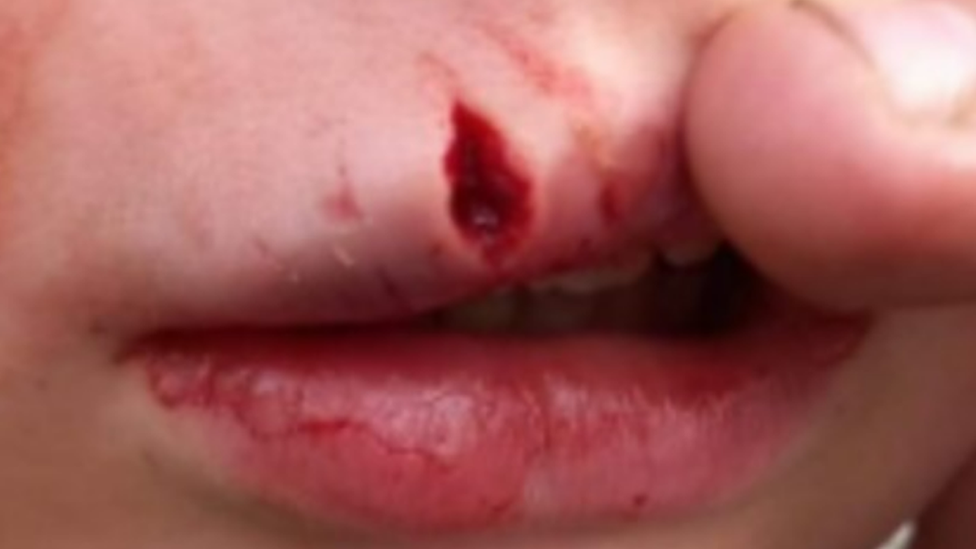 Boy bitten in face by dog in Stoke-on-Trent needs hospital treatment ...
