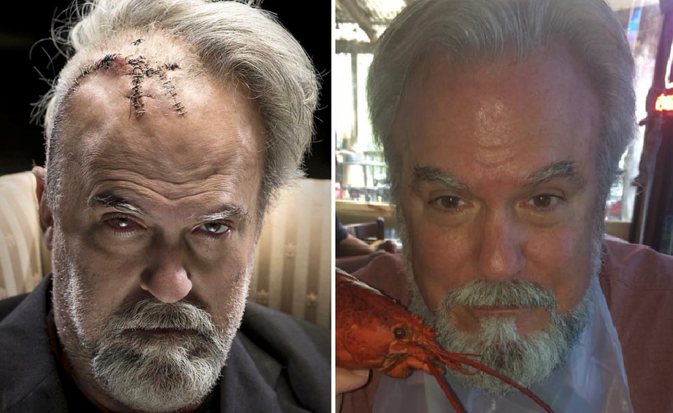 Son transforms dad's brain-op stitches into Bond villain look - BBC News