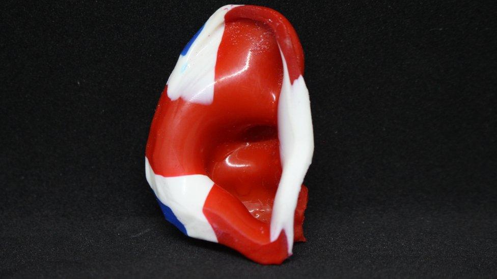 'Cauliflower ear' tackled by silicone ear guard - BBC News