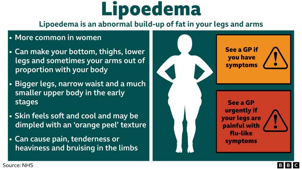 Lipoedema: Love Island star helped me find 'fat built-up' condition ...