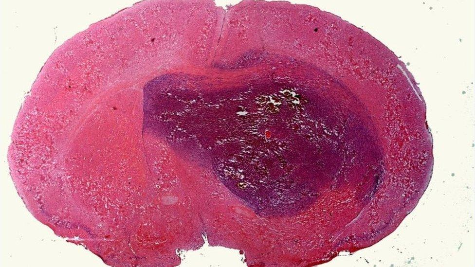 Brain tumour cell fat fuelling find could aid treatment - BBC News