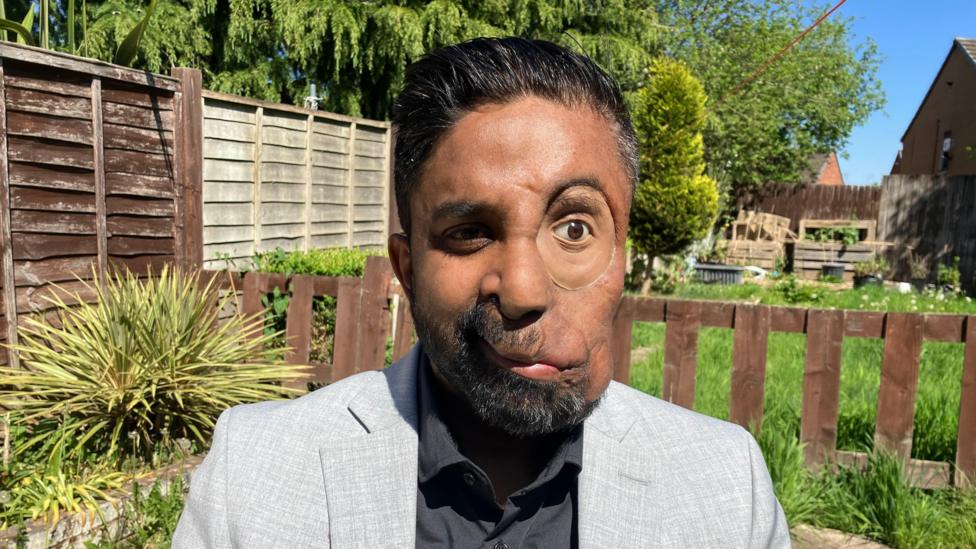 Facial disfigurement: 'I was refused service in a cafe because of my ...