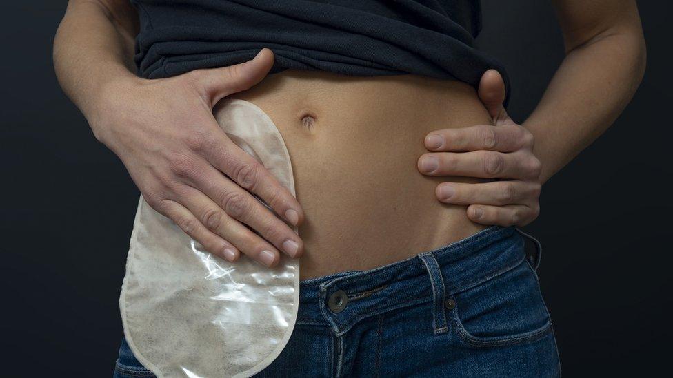 Stoma changing facilities for Shropshire's public buildings - BBC News