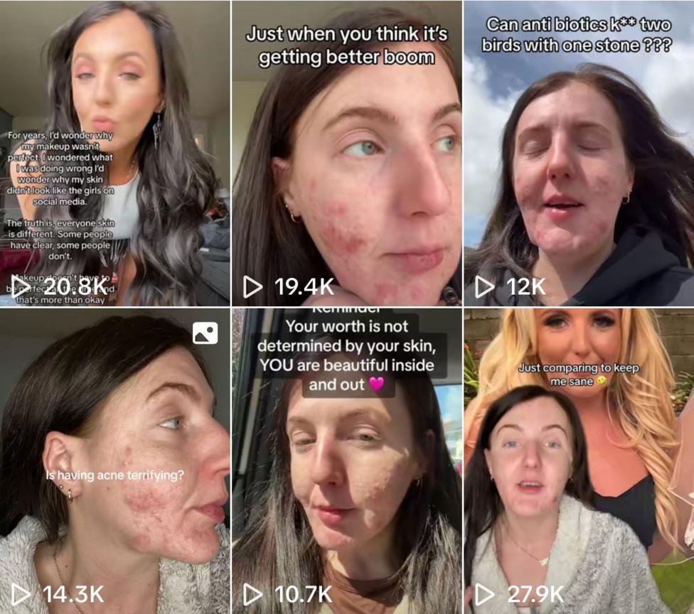 TikTok star with acne films her skin journey to help others - BBC News