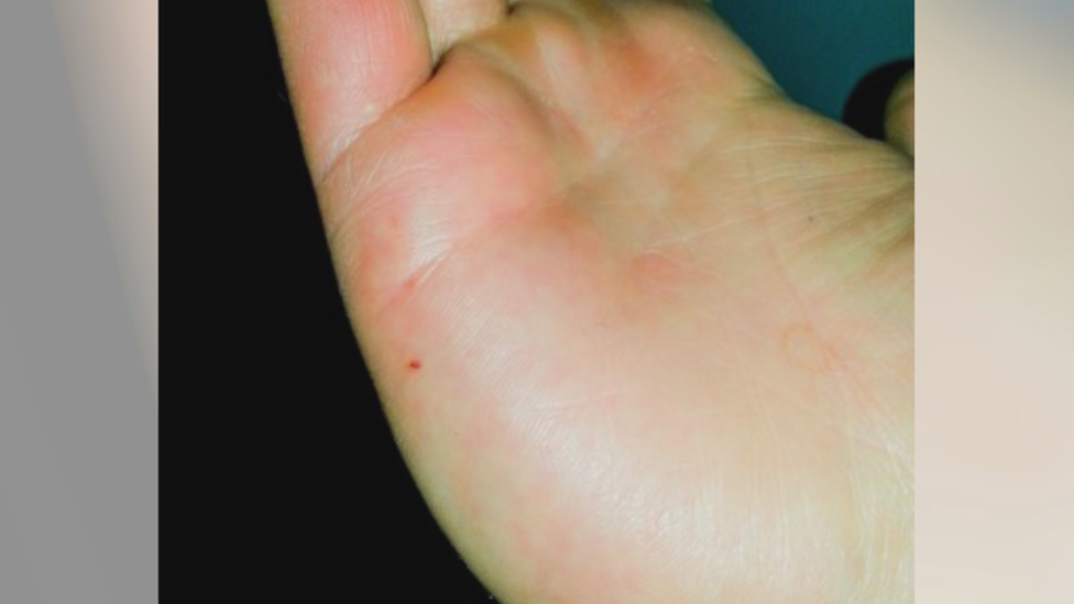 Firefighter gets £1.5m after losing hand in training exercise - BBC News