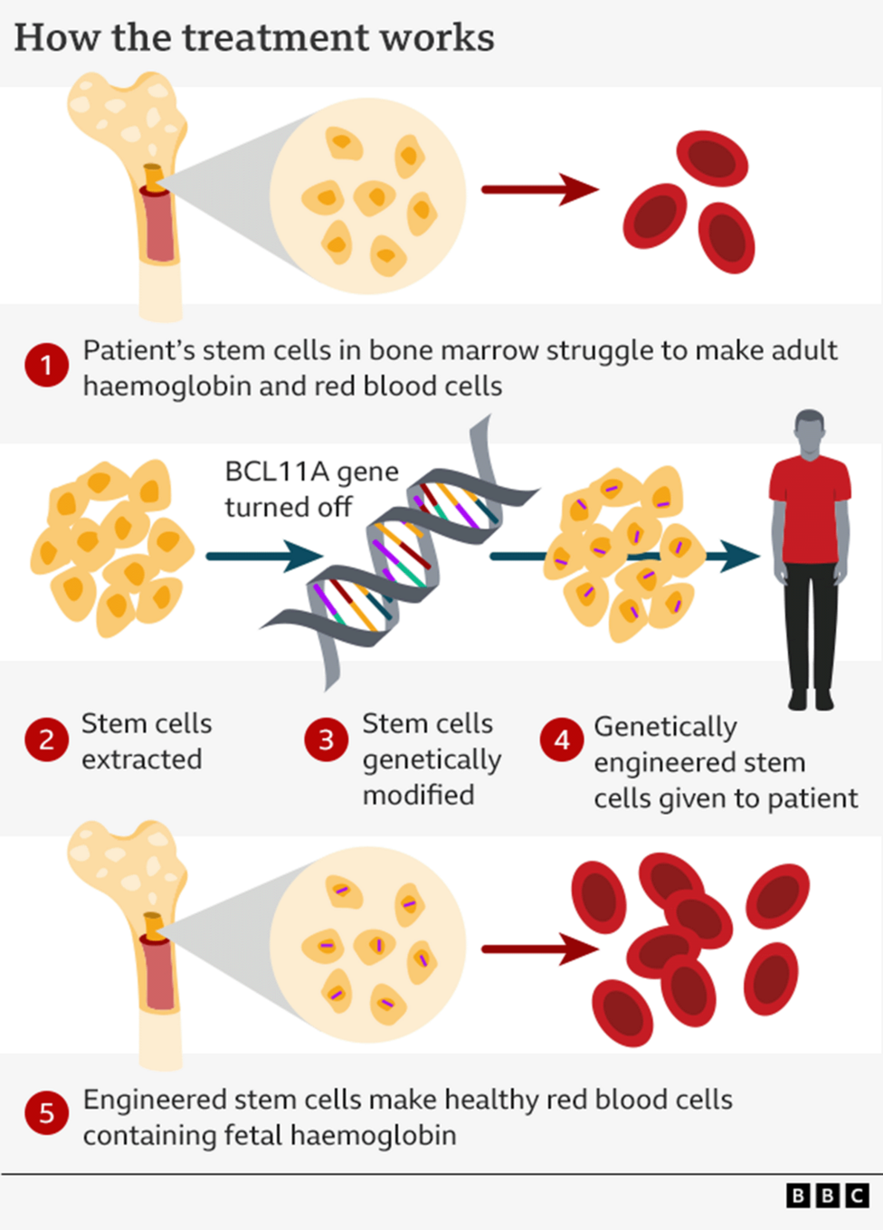 Beta thalassaemia: First gene-editing therapy could cure disorder - BBC News