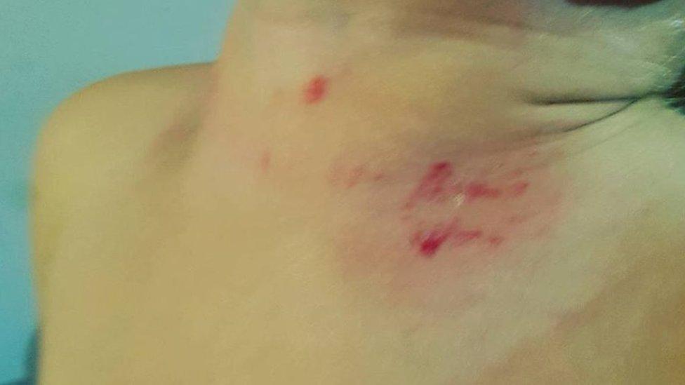 Hickies On Neck Tumblr