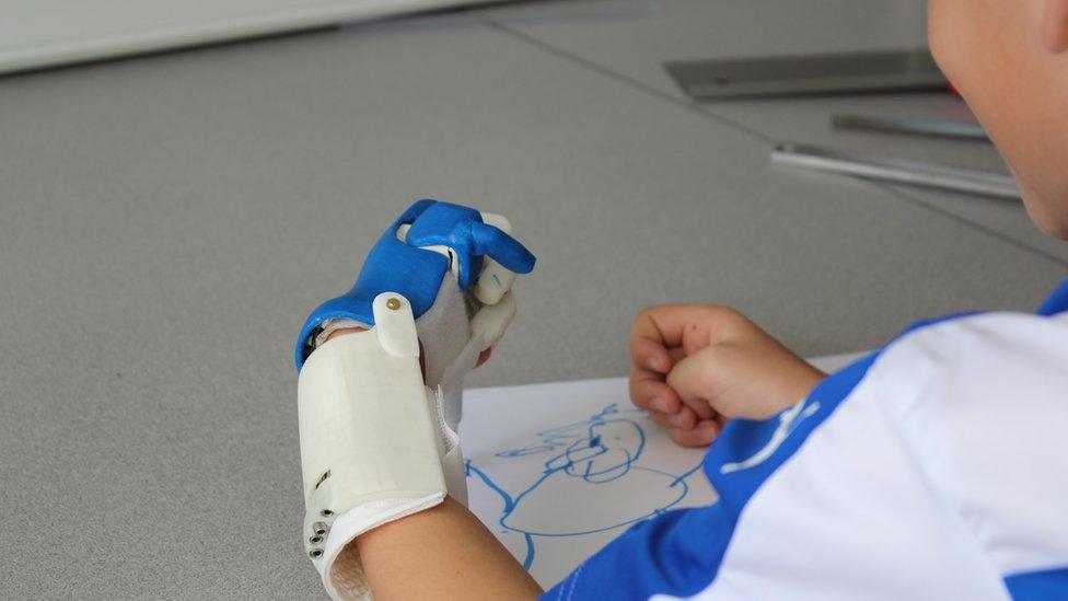 Boy's prosthetic hand printed in Reading FC colours - BBC News