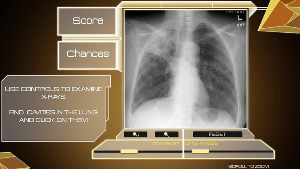 The digital game that could cure TB - BBC News