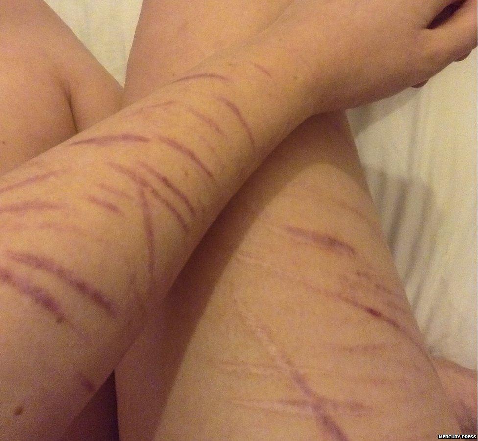 self harm scars on arm