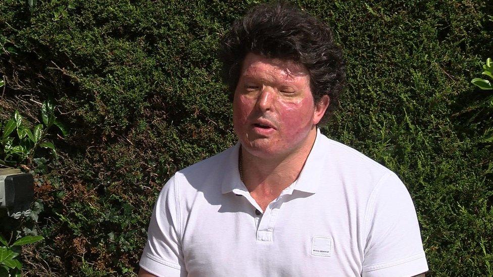 Truro acid attack victim Andreas Christopheros calls for law changes ...